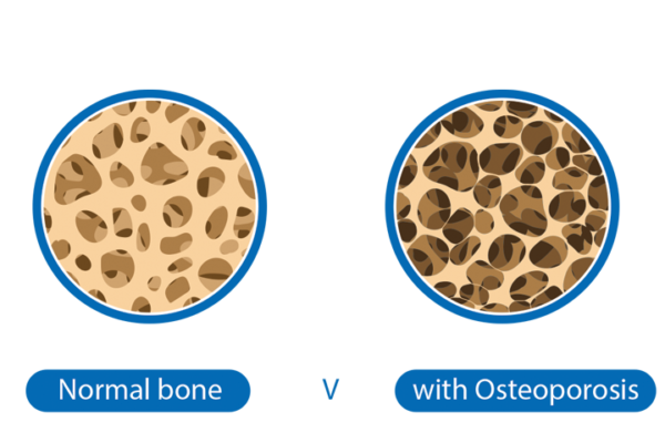 DXA Scan - Irish Osteoporosis Society